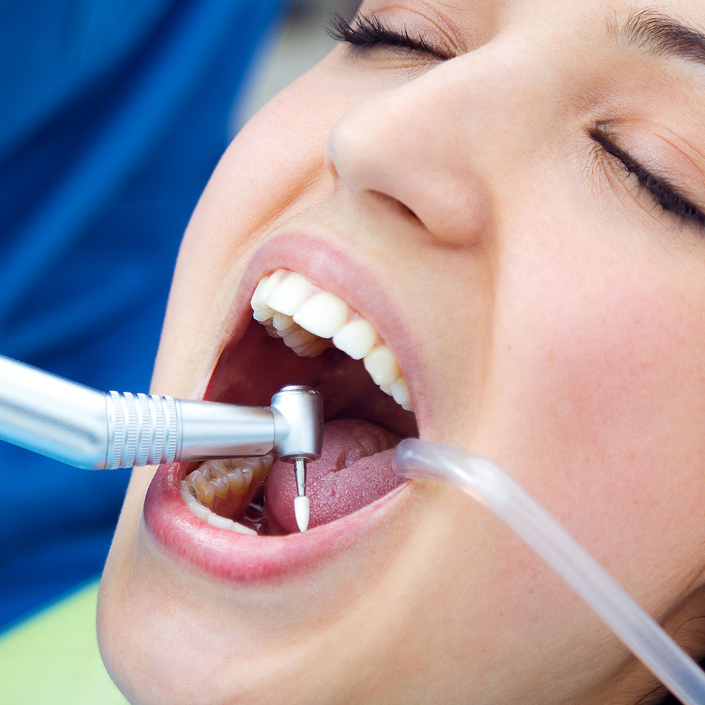 White Composite Fillings - Dazzle Family Dental